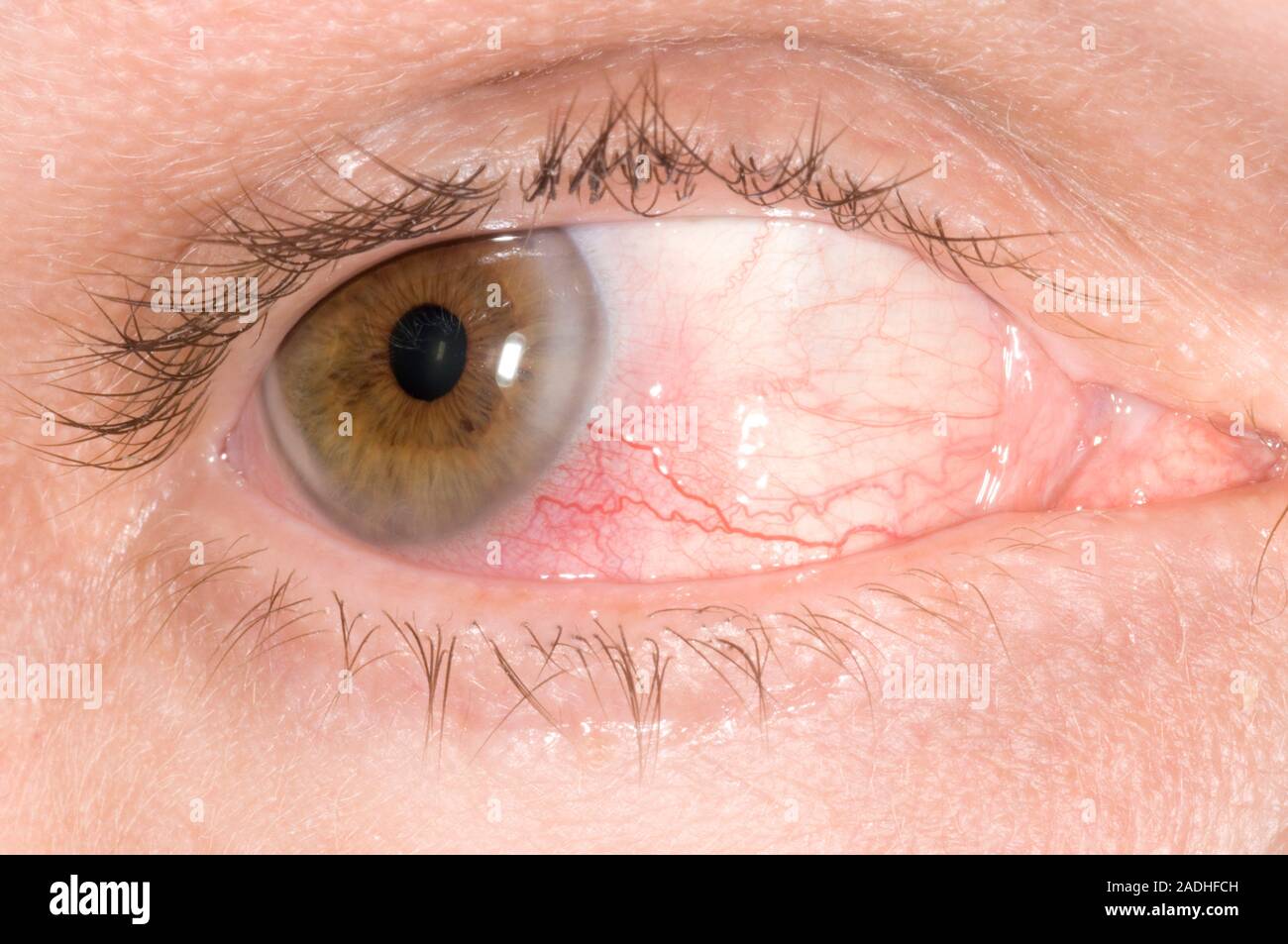 Episcleritis of the eye of a 52 year old man. Episcleritis is the ...