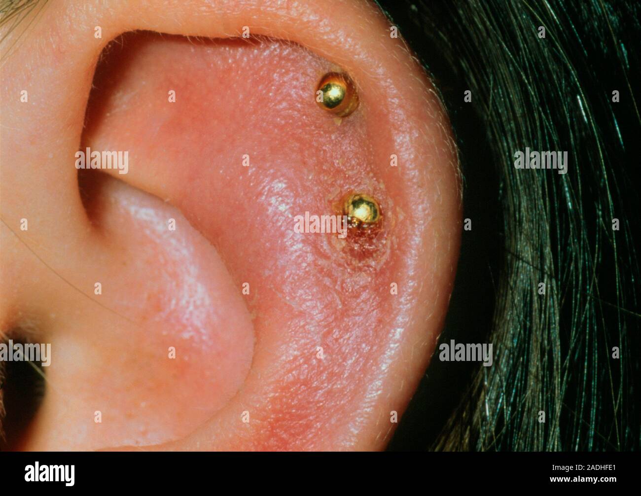 Ear Pinna Infection Close Up Of The Scabby And Inflamed Pinna Of The Ear Of A 16 Year Old Girl