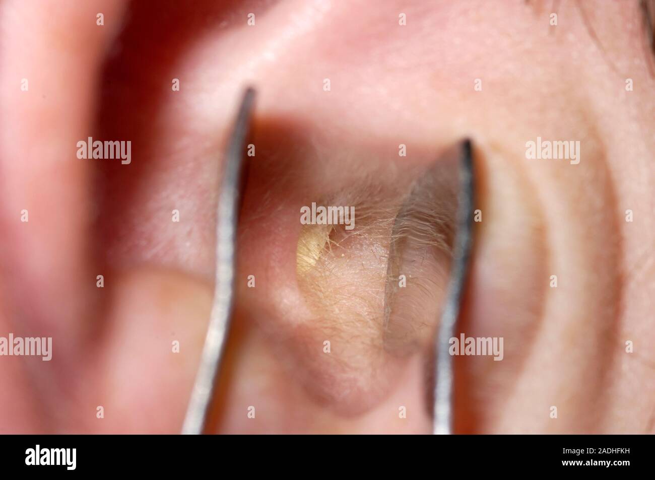 Foreign body in a 17 year old boy's ear. The foreign body is the end of ...