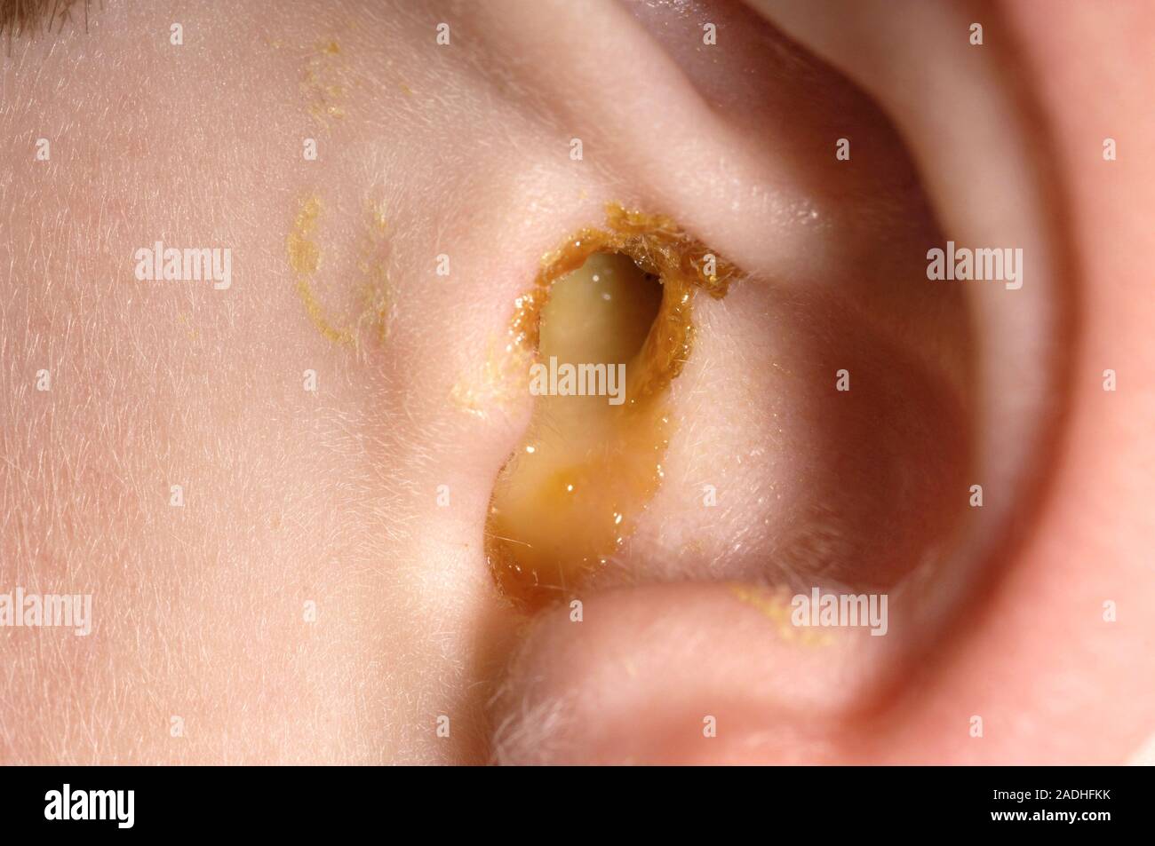 Ear Infection Pus Draining From The Infected Ear Canal Of A 6 Year Old