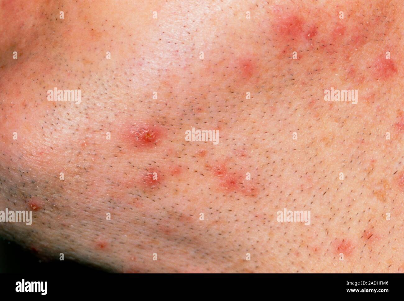 Folliculitis or Sycosis barbae. Infected beard hair follicles, known as ...