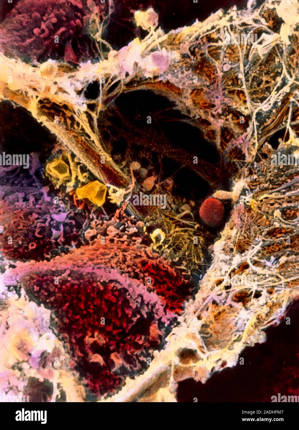 Fibrosis of the liver. Coloured scanning electron micrograph showing ...