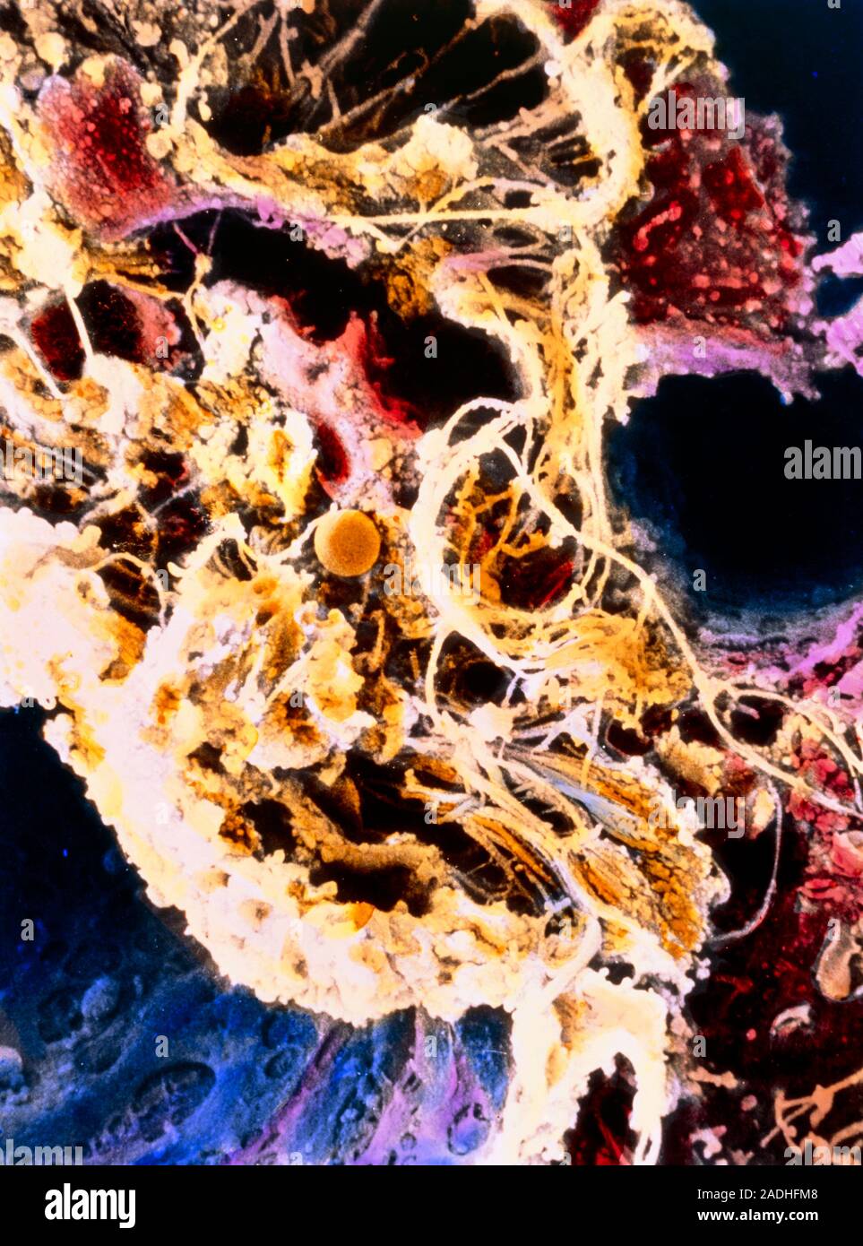 Human fibrosis. Coloured scanning electron micrograph of liver tissue ...