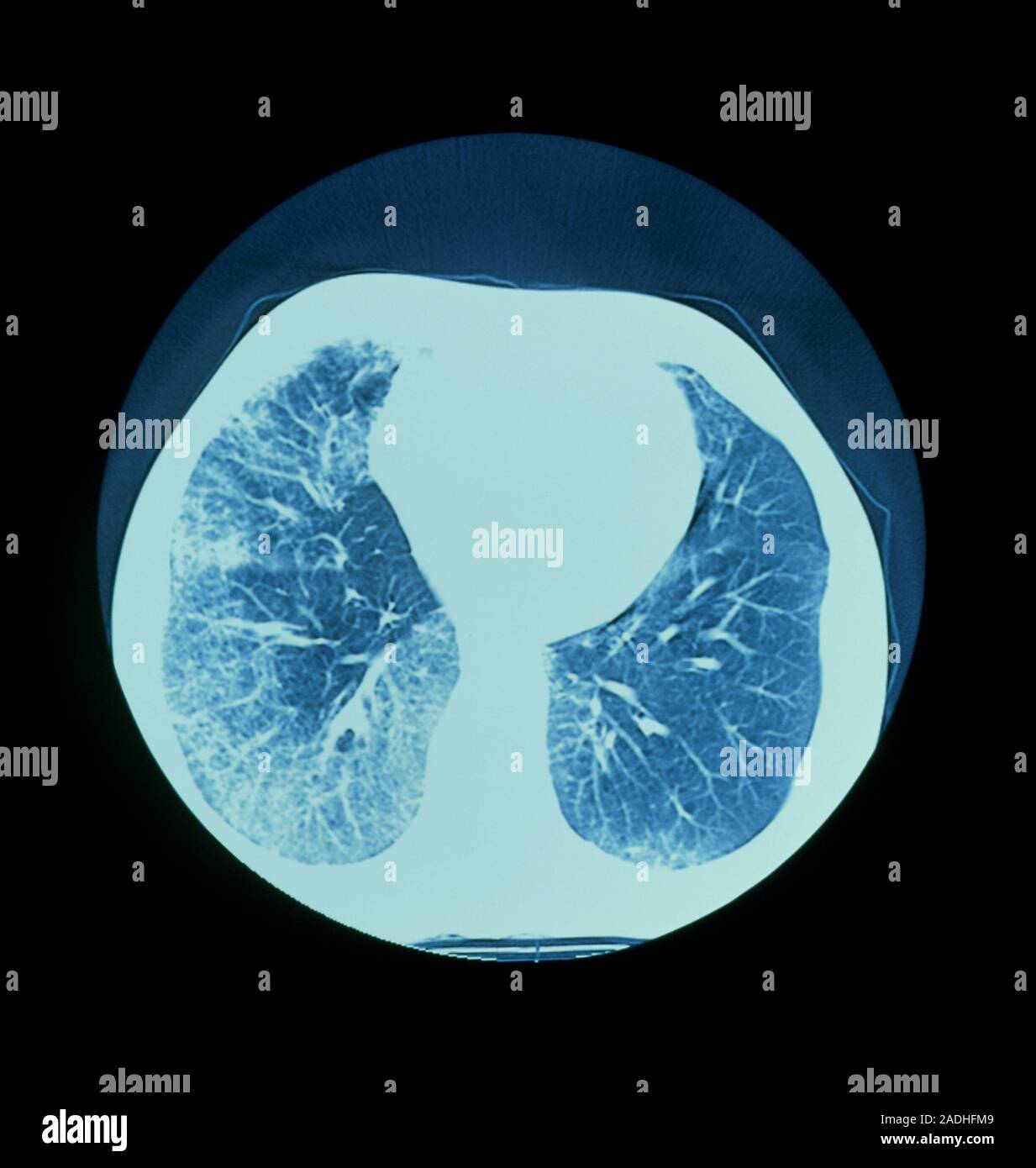Interstitial pulmonary fibrosis (IPF). Computed tomography (CT) scan of ...