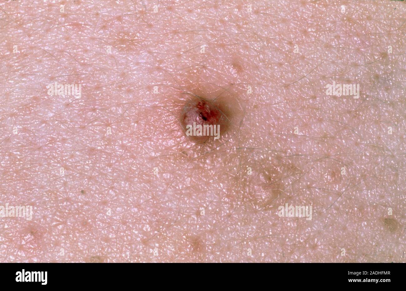 Folliculitis. Close-up of a red skin lesion caused by infection of a ...