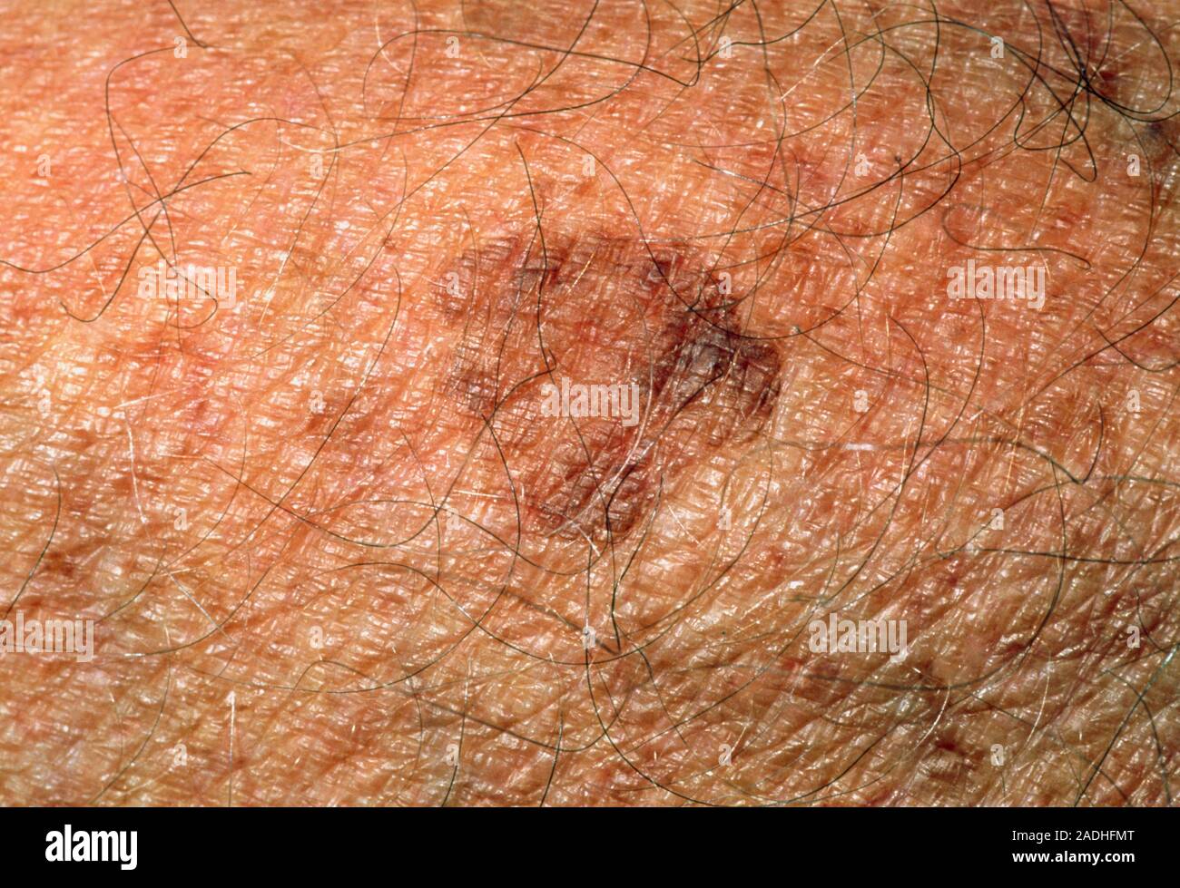 Freckle. Close-up of a freckle, also called an ephelis, on the skin of ...