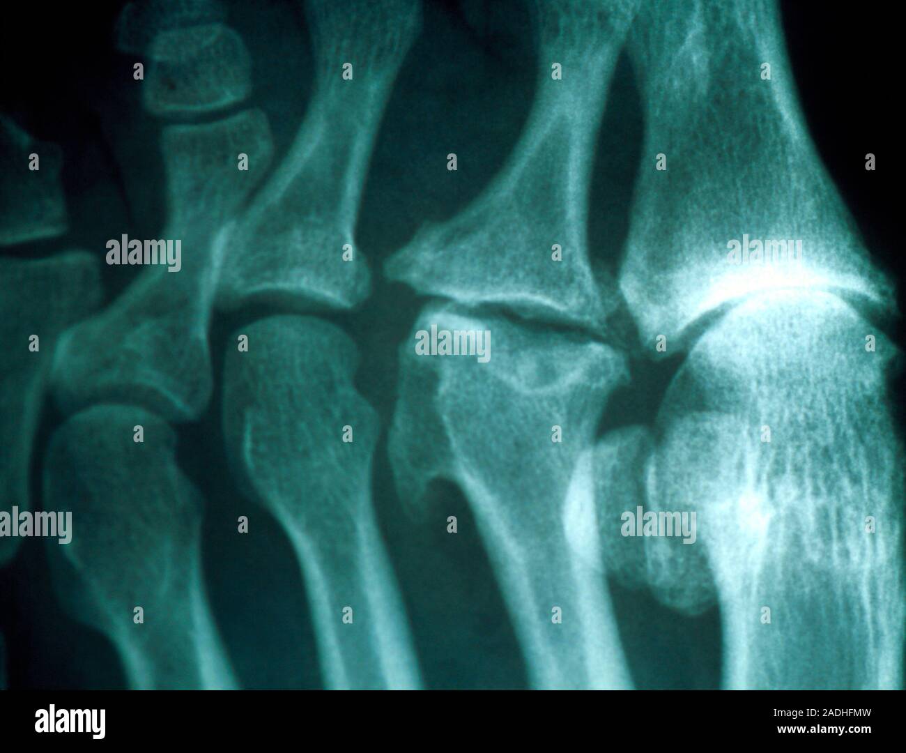 Freiberg's disease. X-ray of the toes of a 50- year-old woman showing ...