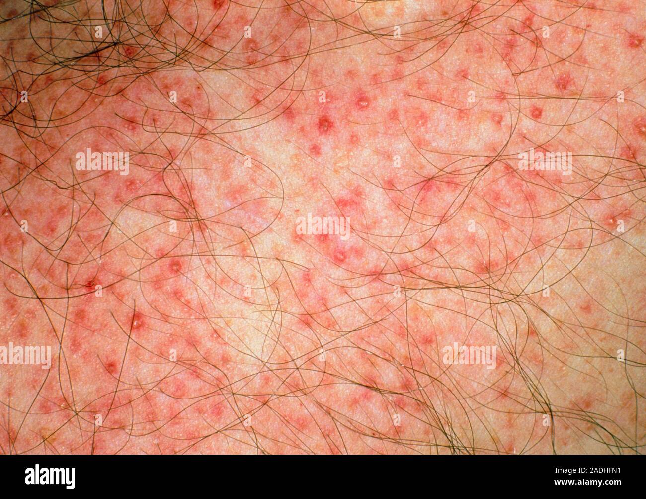 Folliculitis. Close-up of red skin papules caused by an infection of ...
