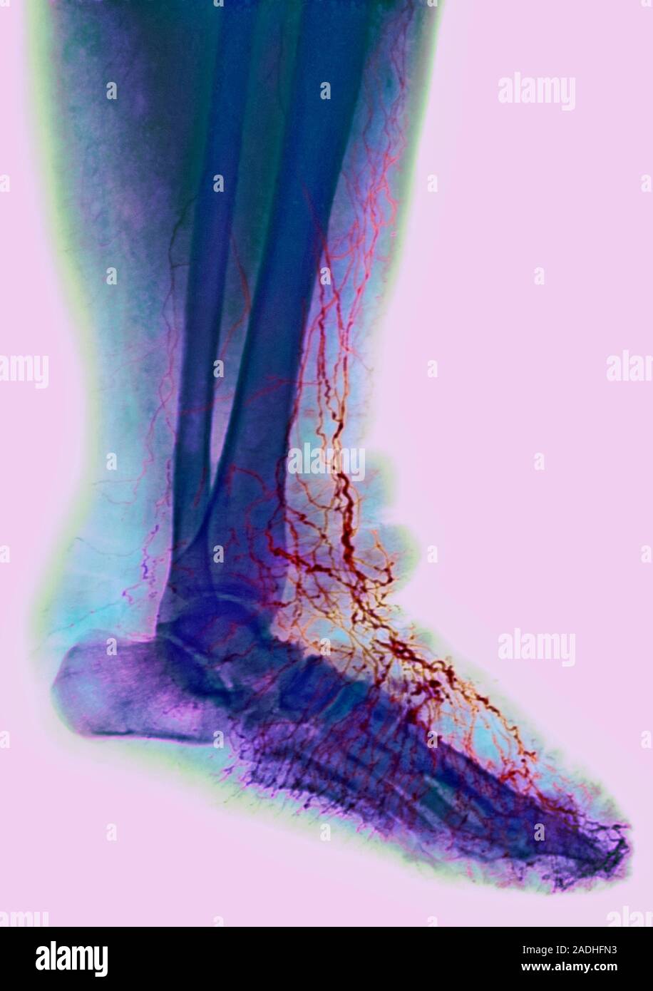 Elephantiasis. Coloured X-ray showing the lower leg of a patient with ...