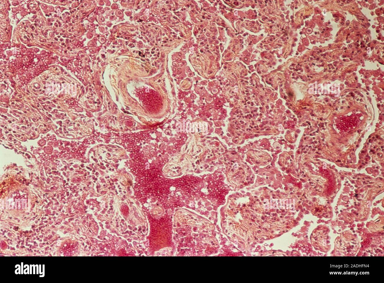 Fibrosis in the lung. Light micrograph of lung tissue showing fibrous ...