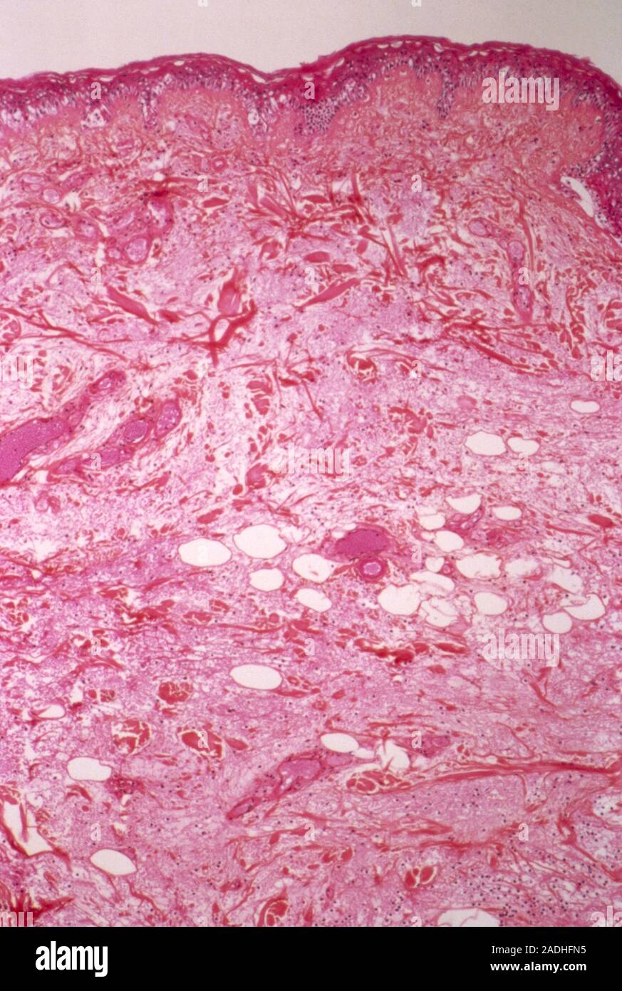 Skin tumour. Light micrograph of a section through human skin ...