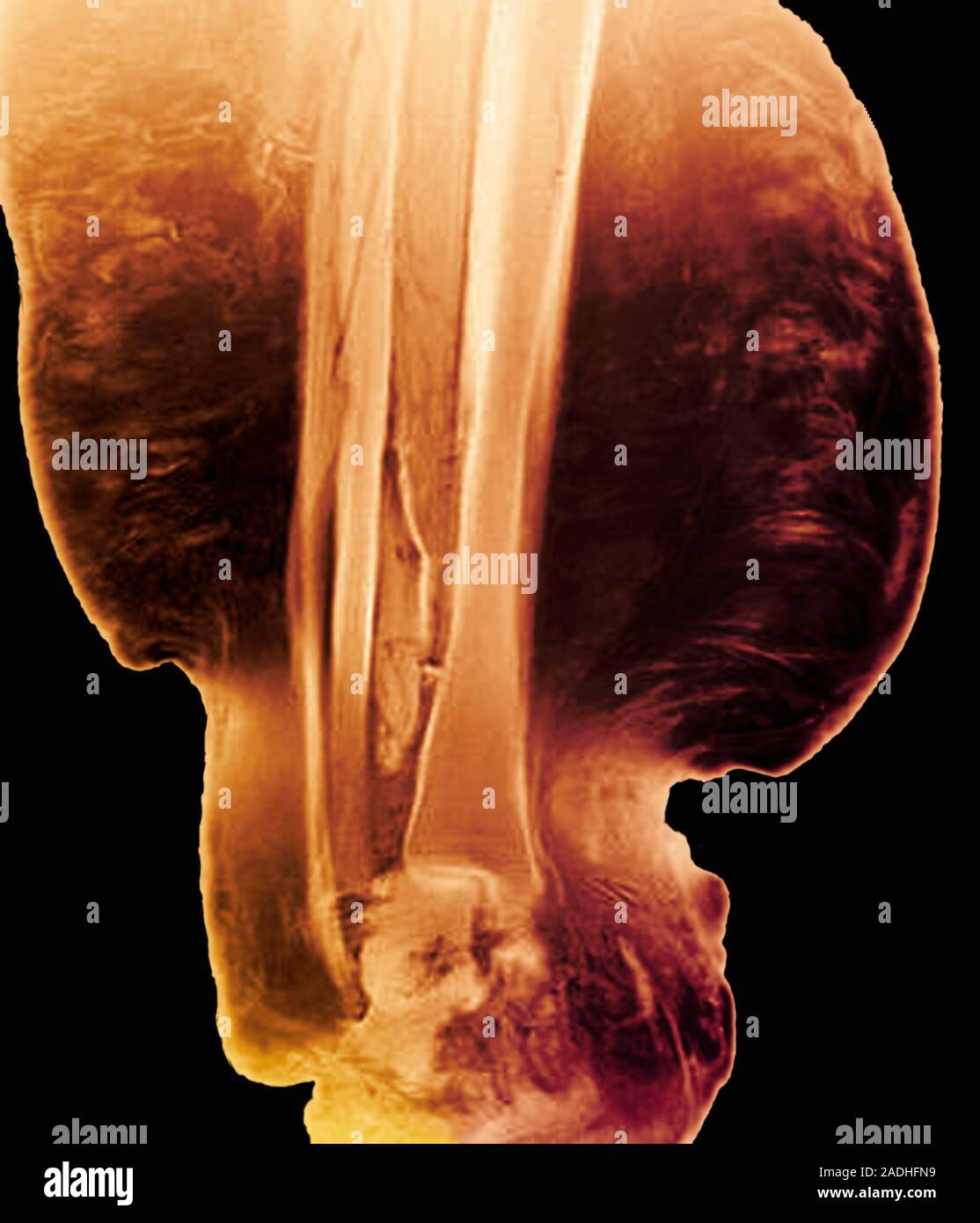 Elephantiasis. Coloured magnetic resonance imaging (MRI) scan showing a ...
