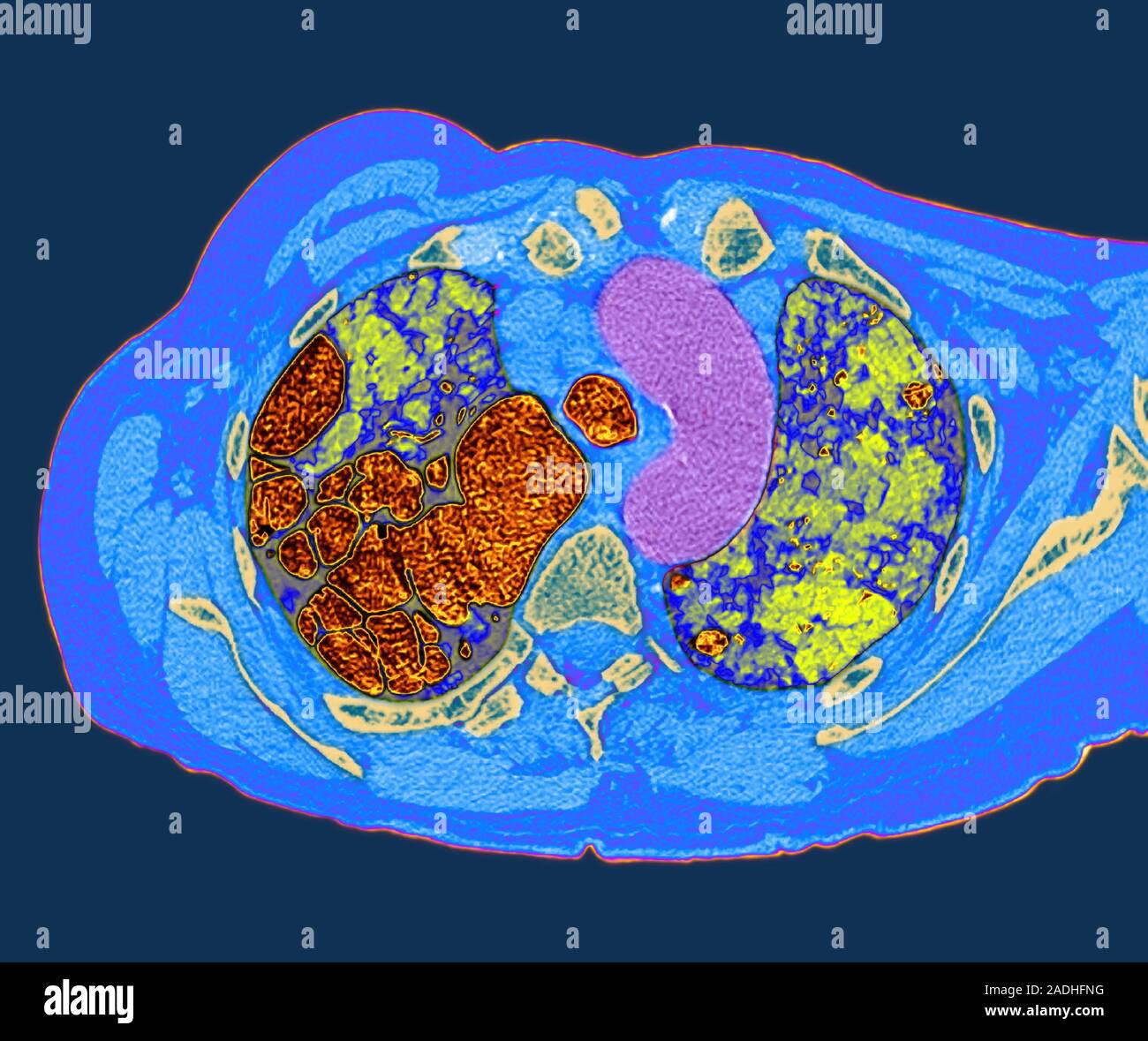 Lung fibrosis. Image 1 of 3. Coloured computed tomography (CT) scan ...