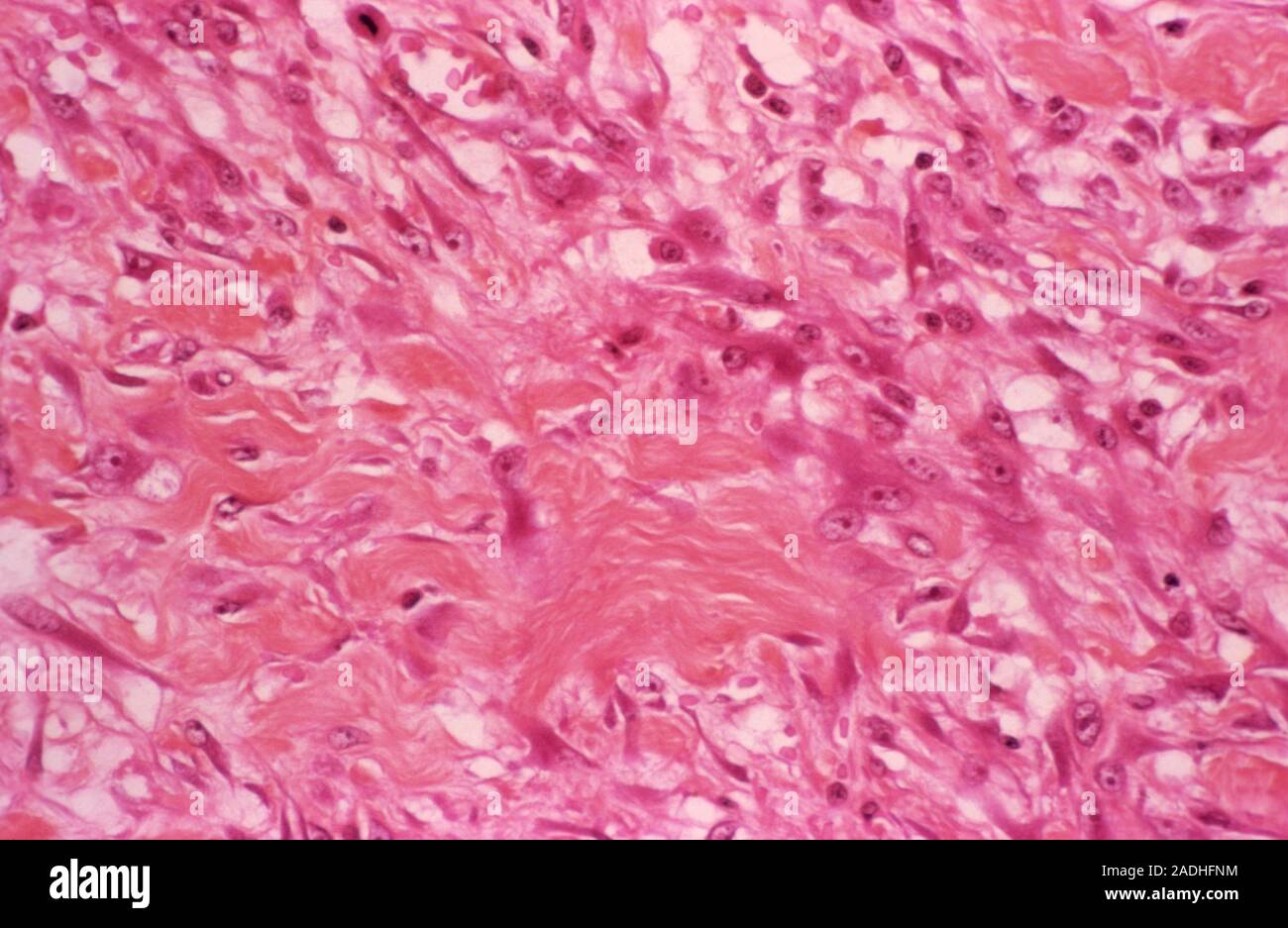 Fasciitis, light micrograph. Fasciitis is the inflammation of fascia ...
