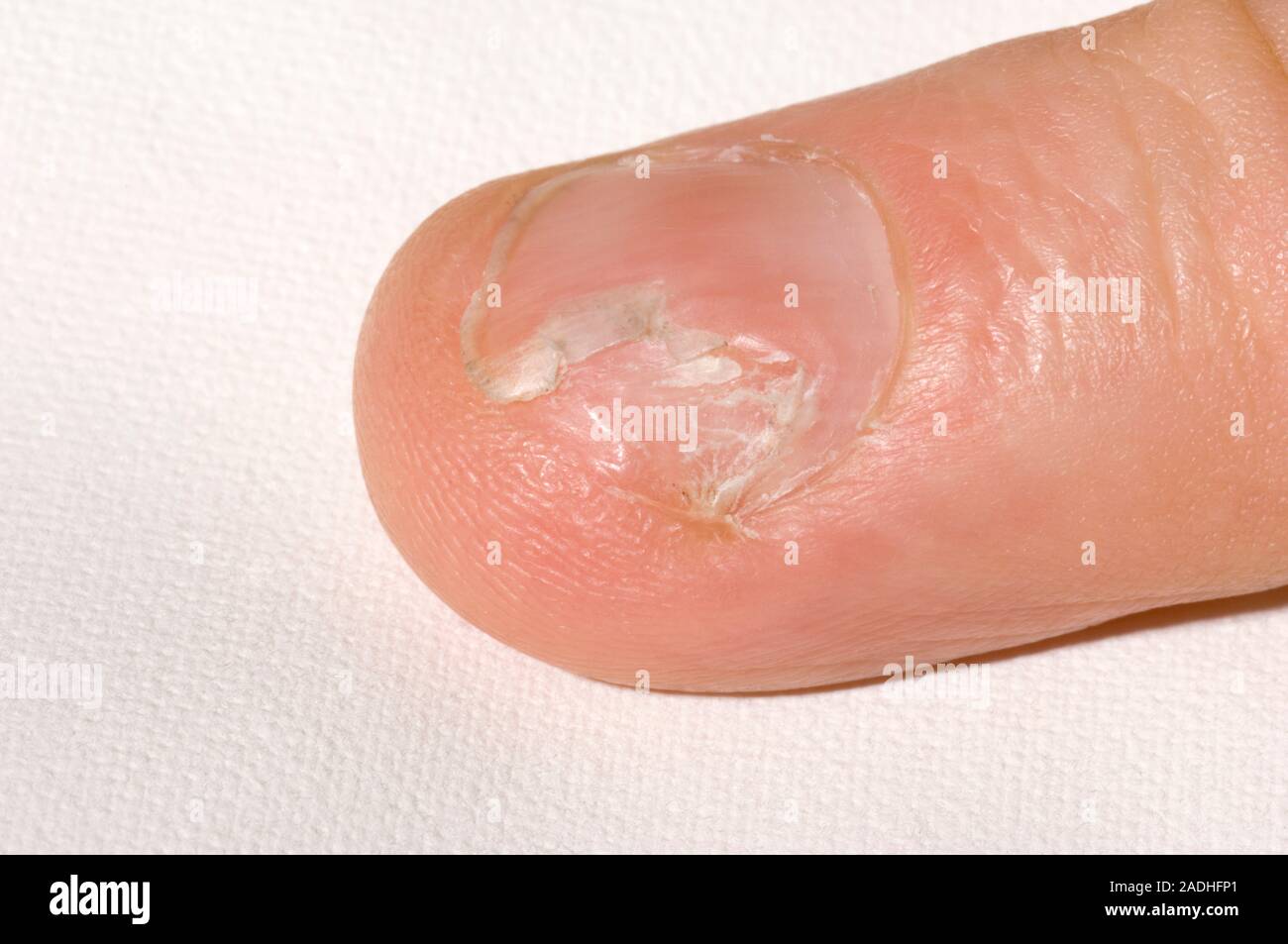 MODEL RELEASED. Fungal nail infection. Damaged nail of a 60 year old ...