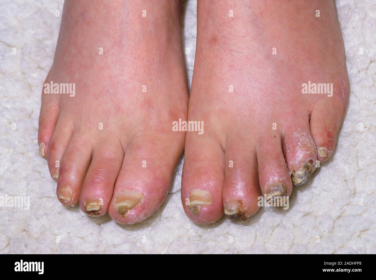 Oedema (swelling) and gangrene affecting a person's toes. Gangrene is a ...