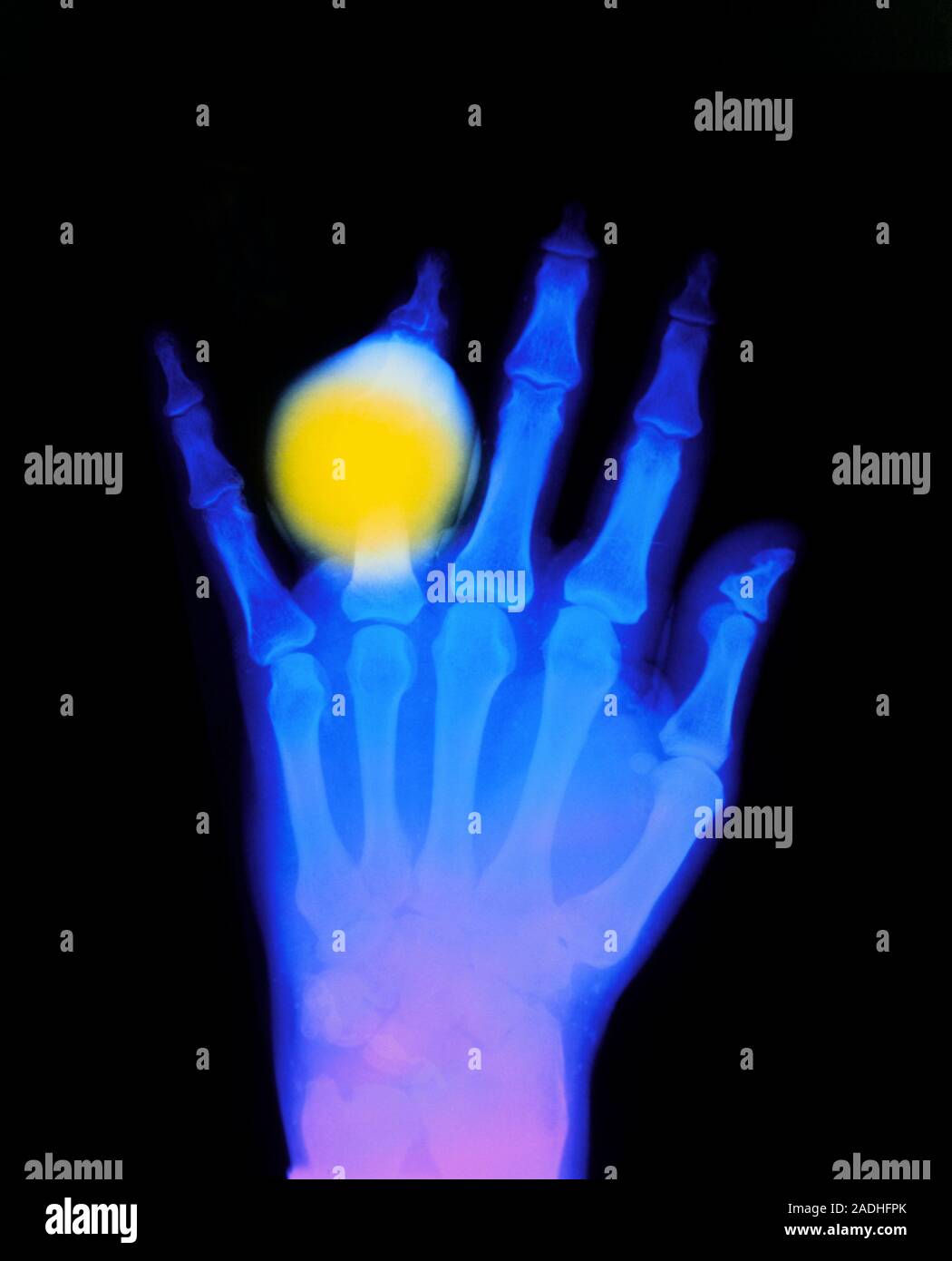 False-colour X-ray of the left hand of a patient suffering from gouty ...