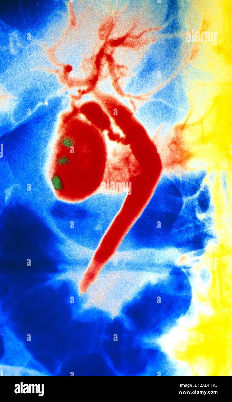 Coloured X-ray showing gallstones within the gall bladder (red, pear ...