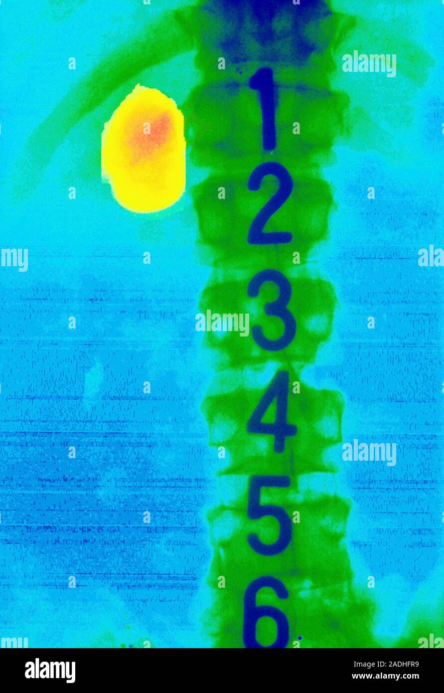 Gallbladder with gallstones. Coloured digitised X- ray of the abdomen ...