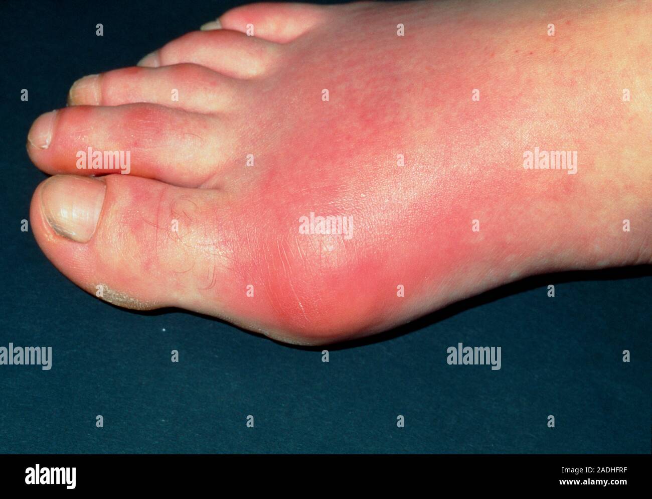 Gout. Close-up of the foot of a patient with gout, showing an inflamed ...