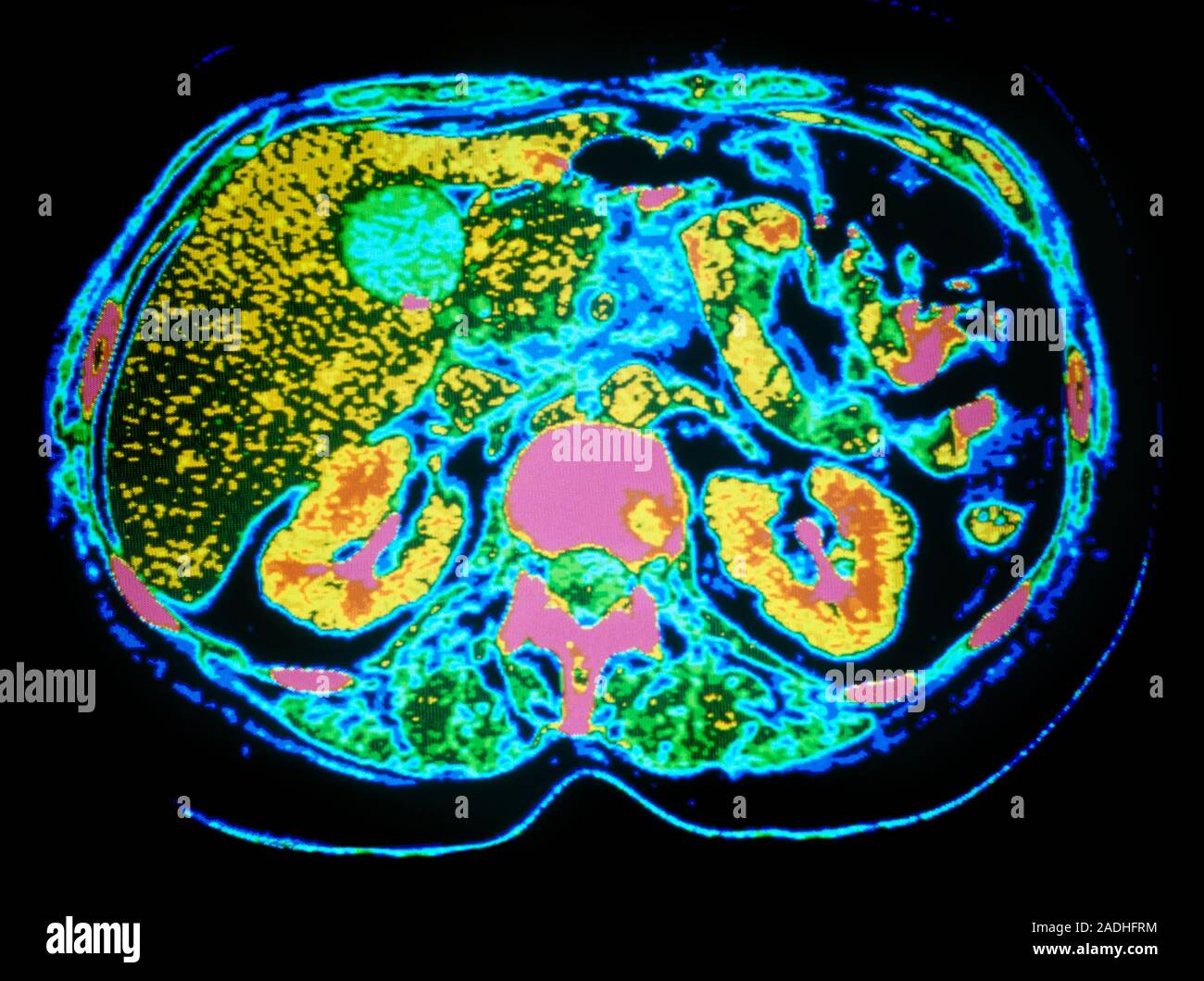 Gallstone. Coloured computed tomography (CT) scan of an axial section ...