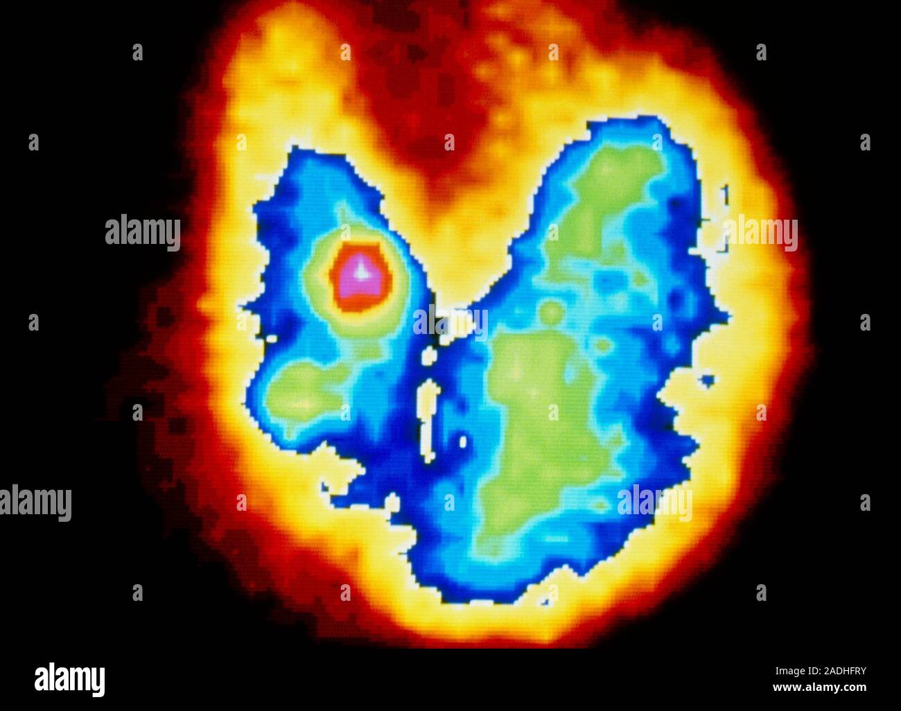 Multinodular goitre. Coloured Gamma Scan of a goitre of the thyroid ...