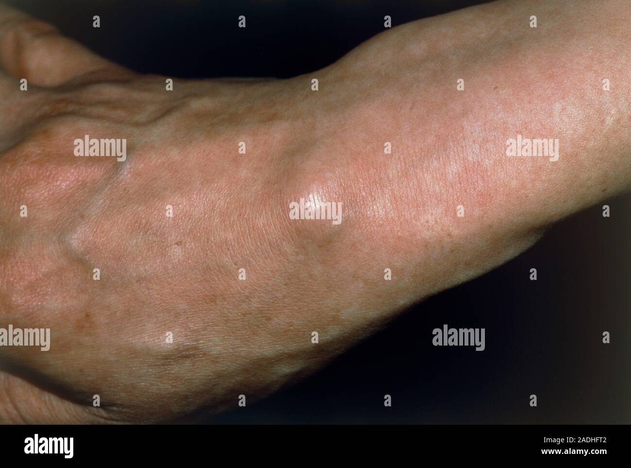 Ganglion on the forearm of a patient. This is a cystic swelling ...