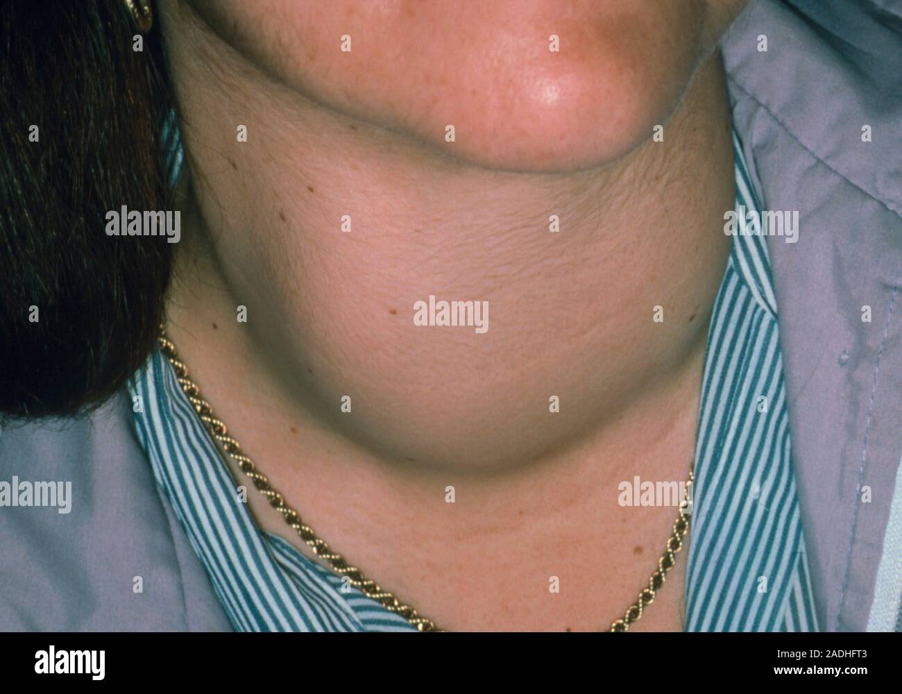 Thyrotoxic goitre. Goitre (swollen neck) seen on a woman patient ...