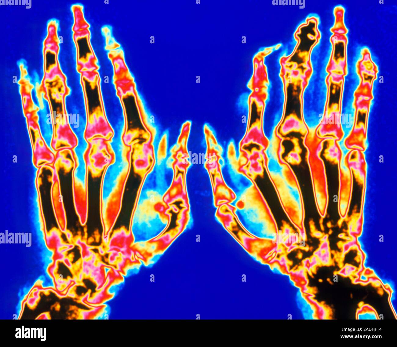 Gouty hand. Coloured X-ray image of the hands of a patient suffering ...