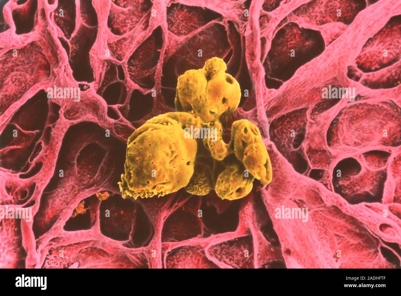 Gall stone. Coloured scanning electron micrograph (SEM) of a gall stone ...
