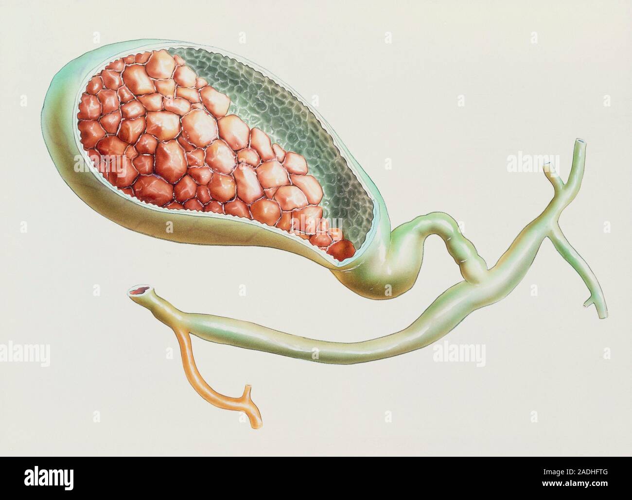 Gall stones. Artwork showing gall stones in the gall bladder. The gall ...