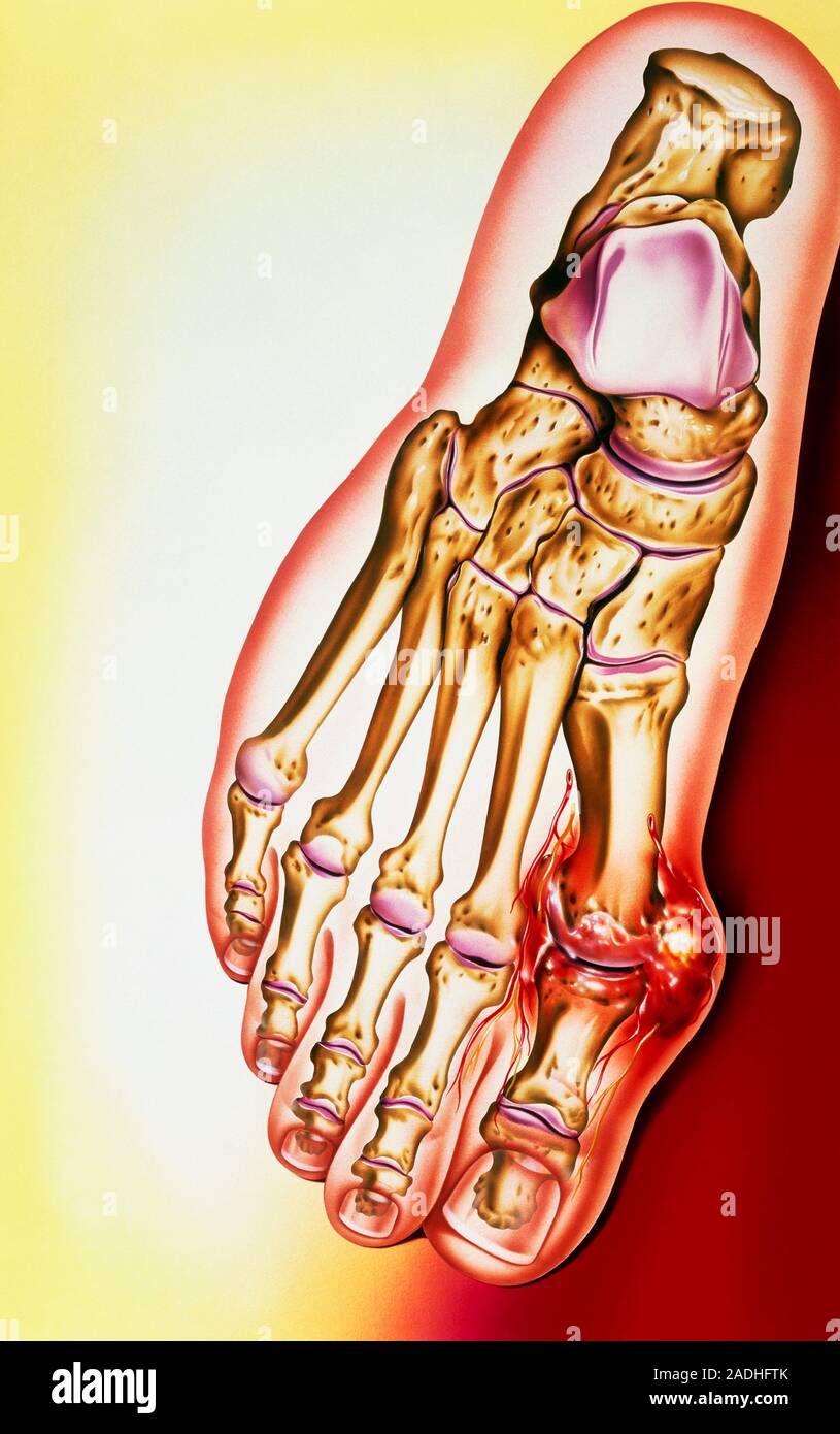 Tophus due to gout. Artwork of the bones of a foot, showing a tophus ...