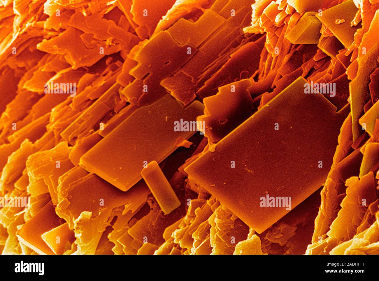 Gallstone. Coloured scanning electron micrograph (SEM) of the surface ...