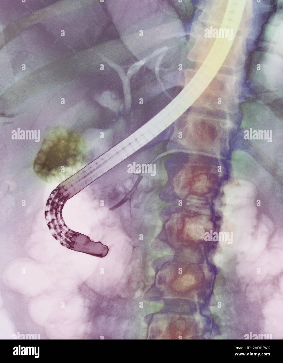 Gallstones. Coloured X-ray of gallstones (green) in a patient's gall ...