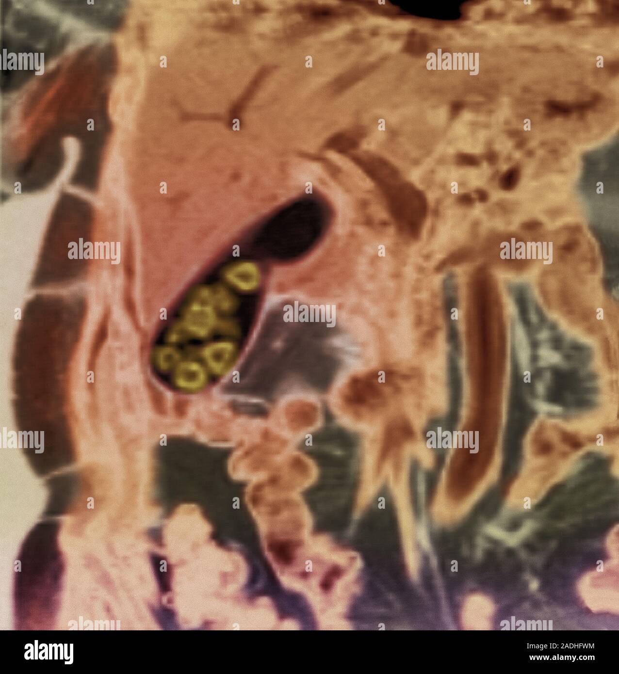 Gallstones. Coloured magnetic resonance imaging (MRI) scan showing a ...