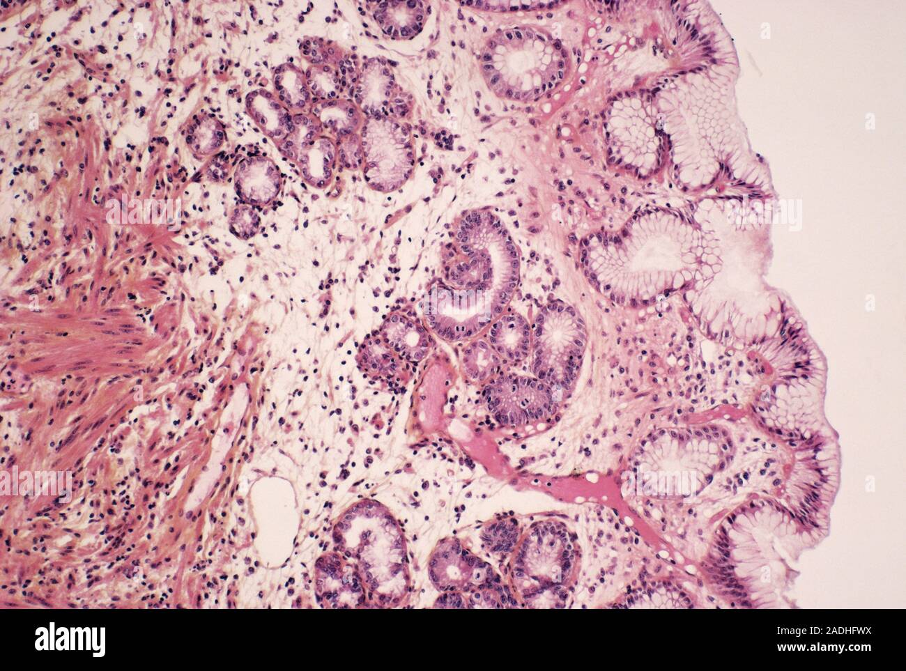 Atrophic gastritis. Light micrograph section of atrophic cells of the ...