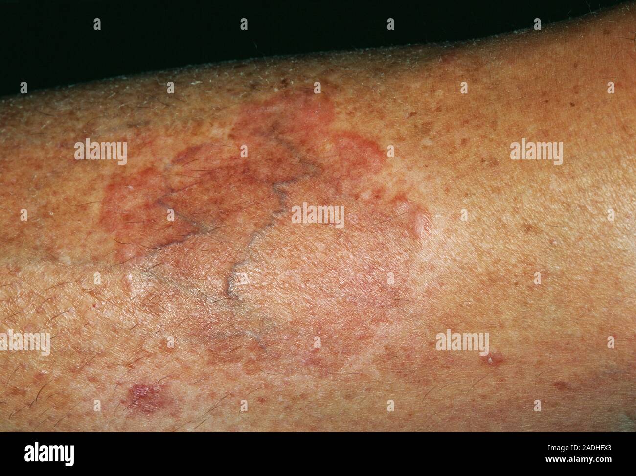 Skin lesions. Close-up of the leg of a 57-year-old female patient ...