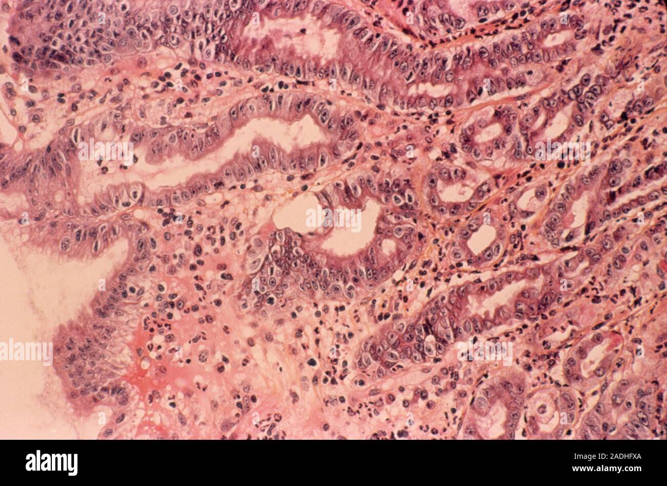 Gastritis. Light micrograph of a section through the inflamed lining ...