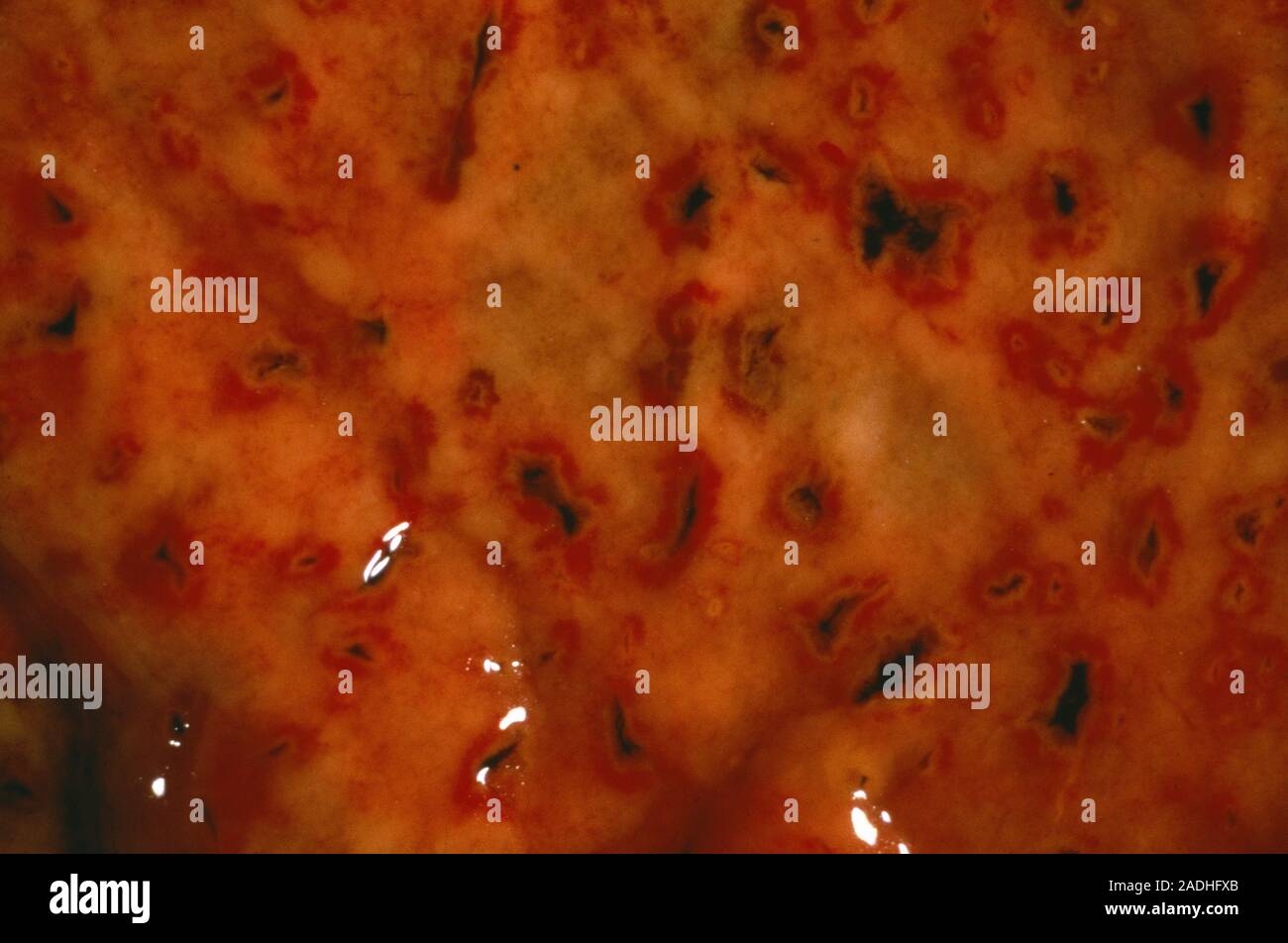 Gastritis. Gross clinical specimen of the inflamed lining (mucosa) of ...