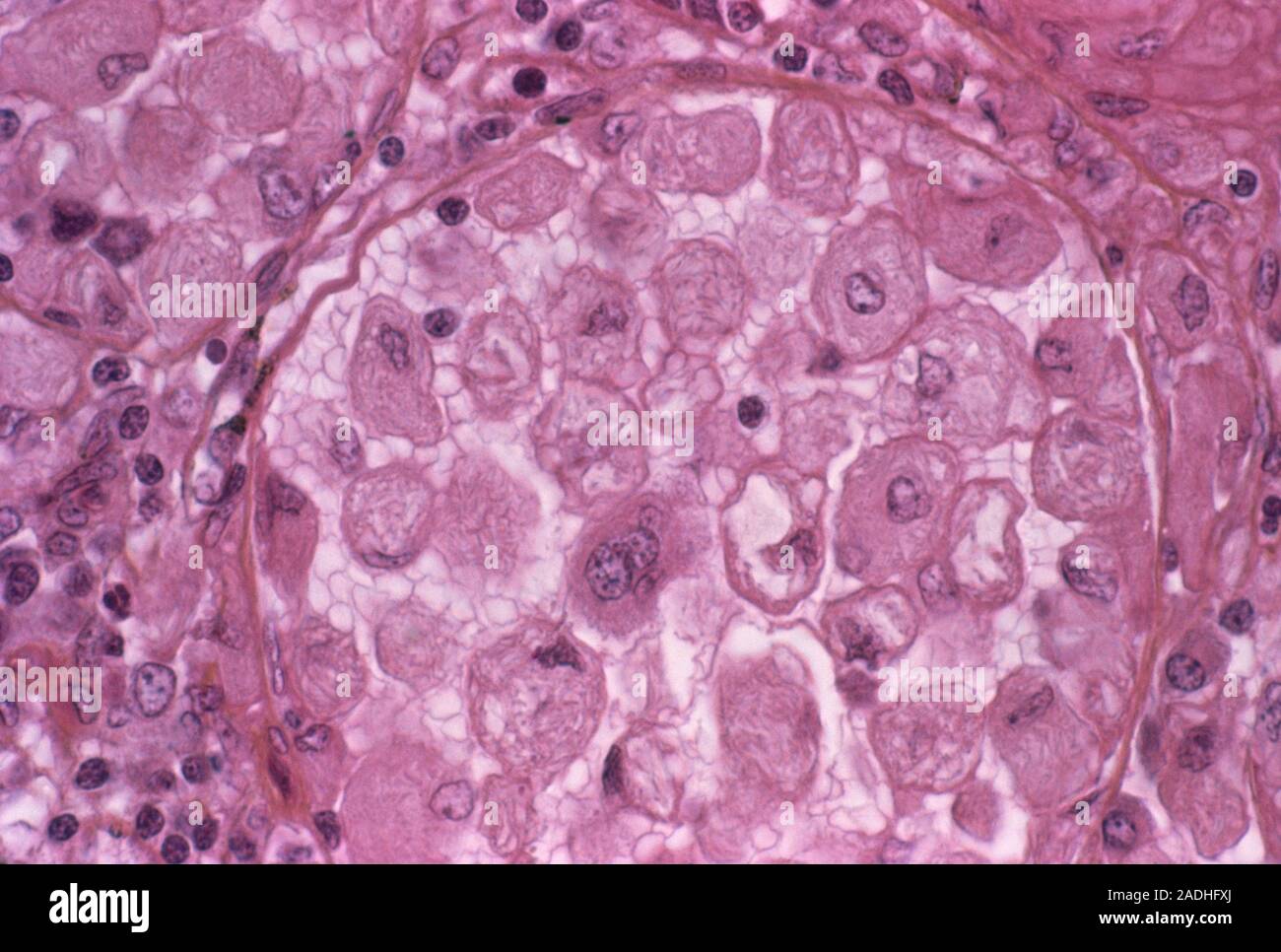 Gaucher's disease. Light micrograph of a section through the spleen of ...