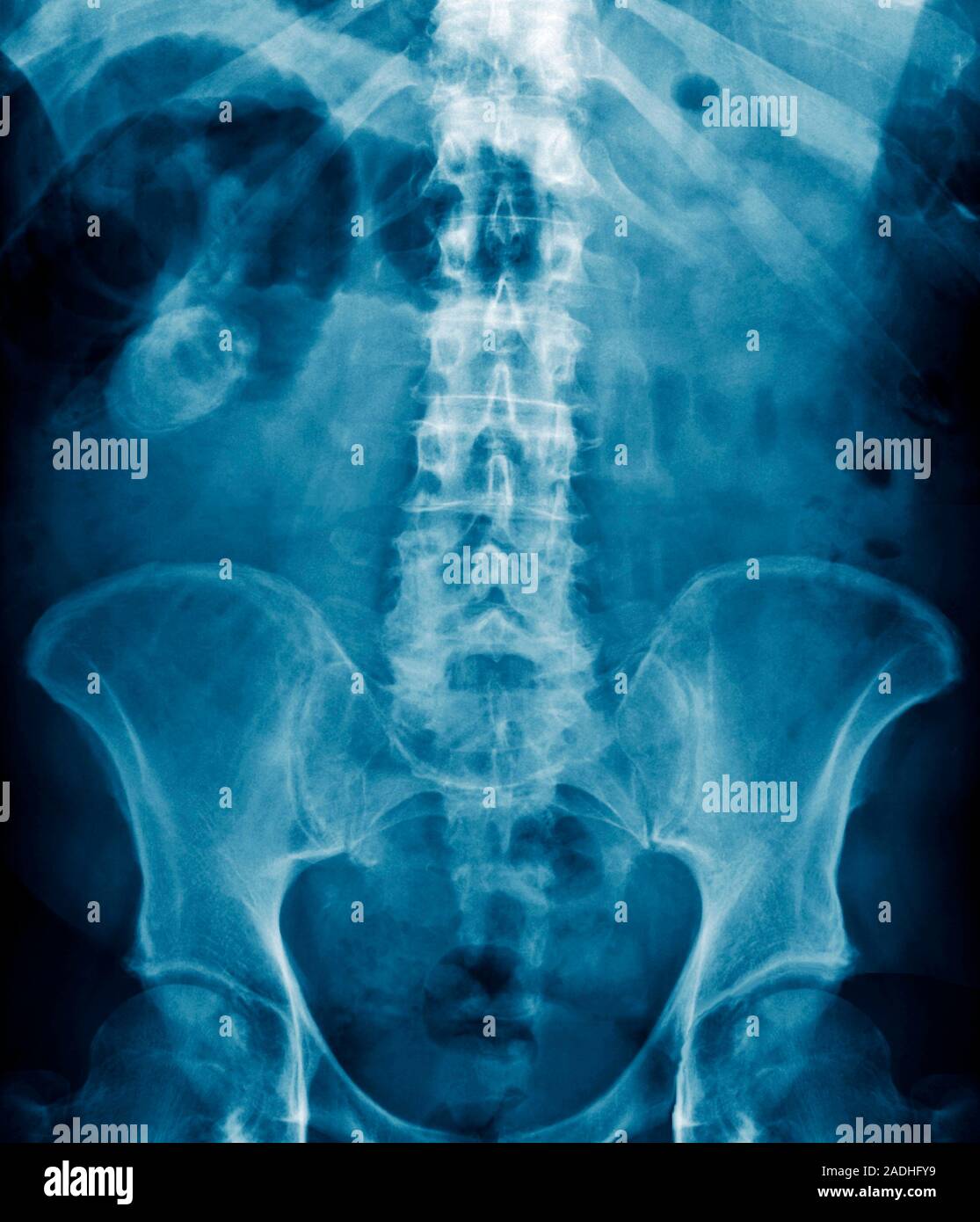 Gallstone, frontal X-ray. Gallstones form in the gallbladder when ...