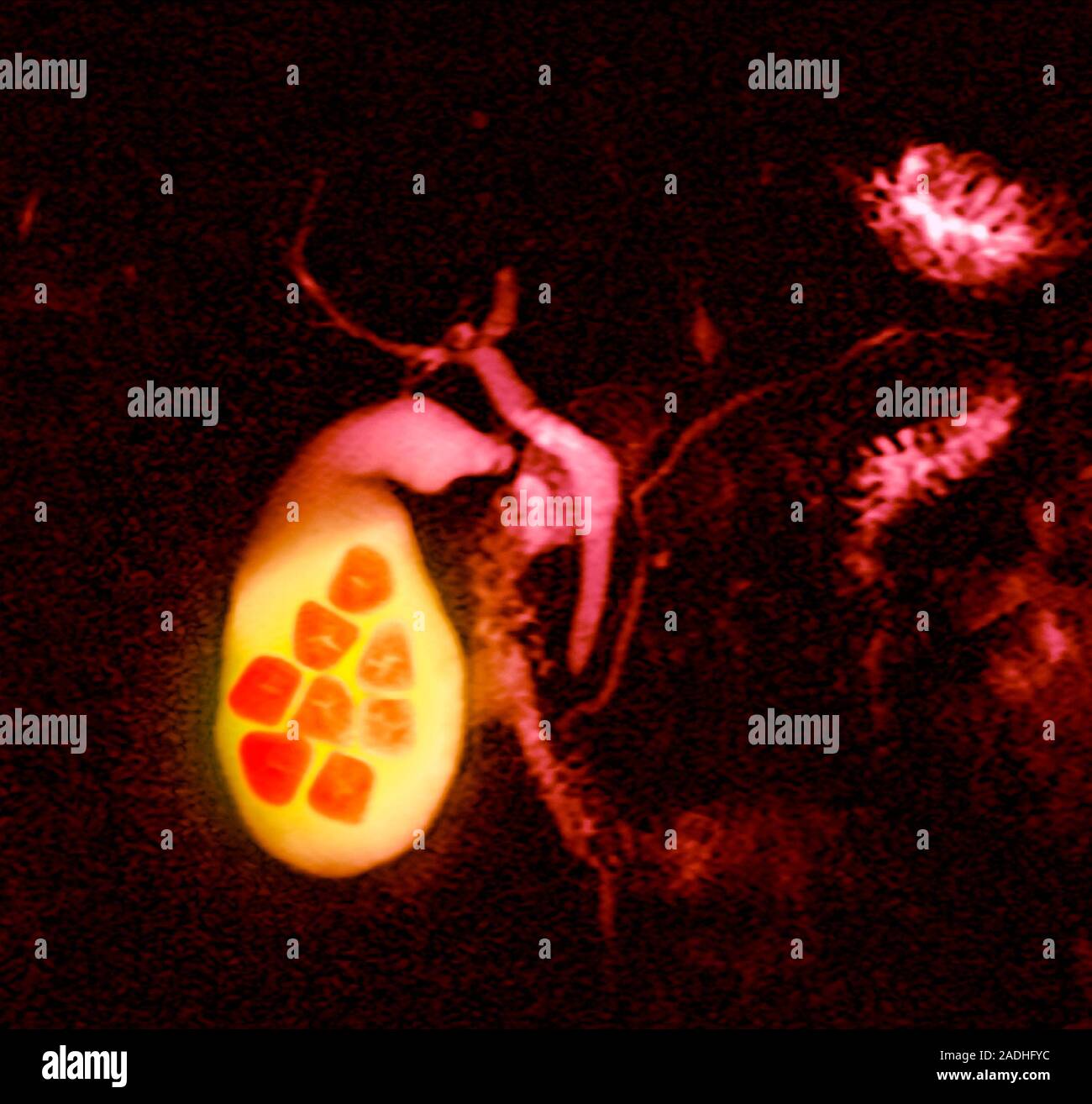 Gallstones. Coloured MRI (magnetic resonance imaging) scan of ...