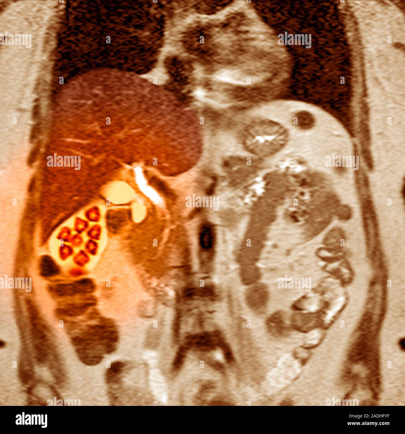 Gallstones. Coloured MRI (magnetic resonance imaging) scan of the ...