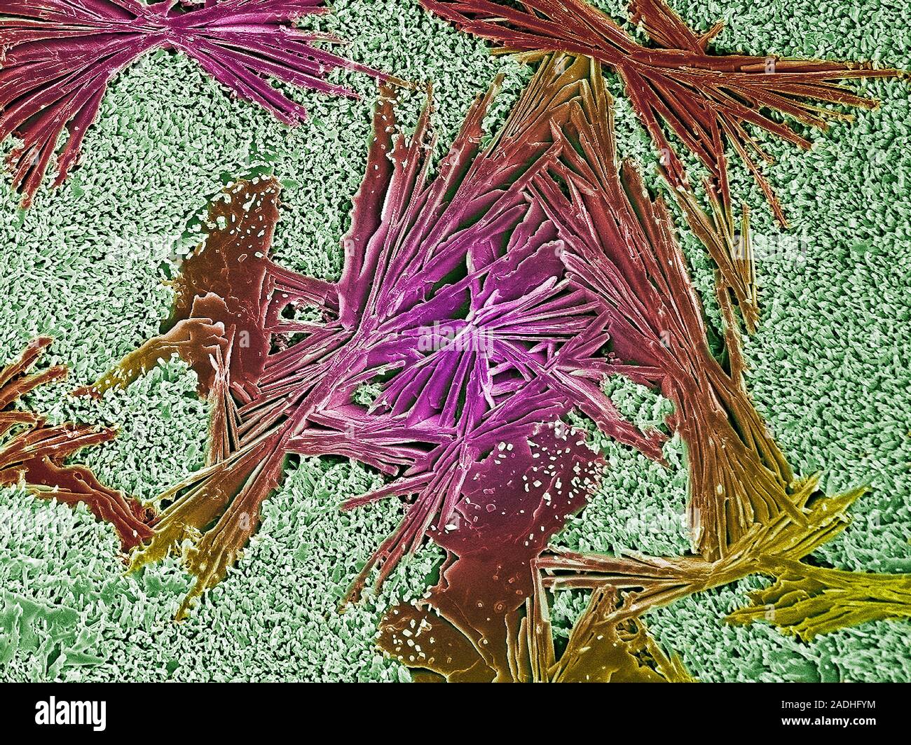 Gallstone crystals. Coloured scanning electron micrograph (SEM) of a ...