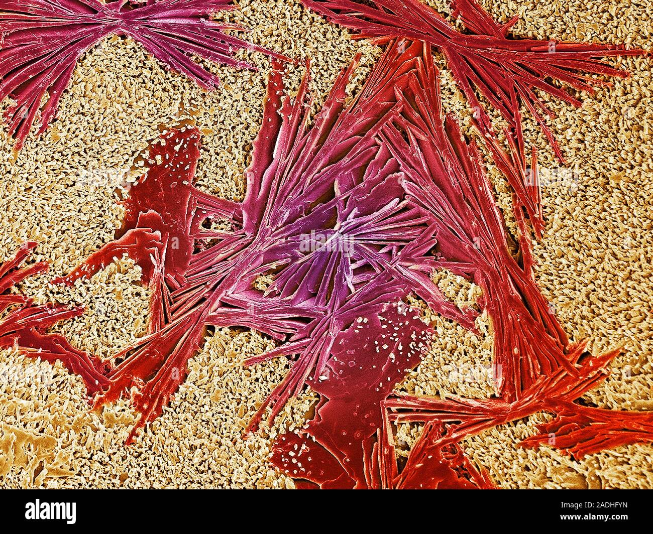 Gallstone crystals. Coloured scanning electron micrograph (SEM) of a ...