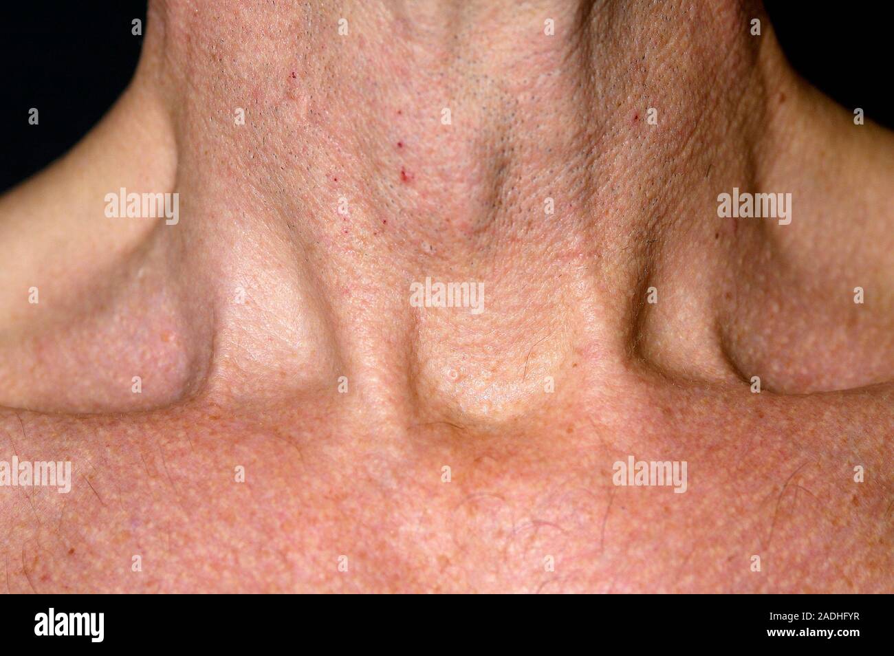 Swollen thyroid gland at the base of the throat of a 51-year-old man ...