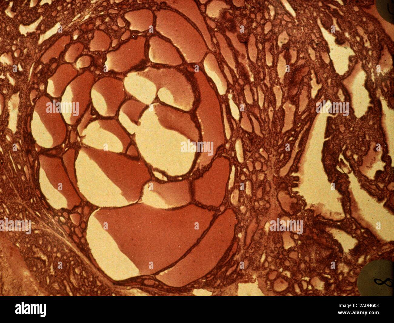 Goitre. Light micrograph of a section through a thyroid gland affected ...