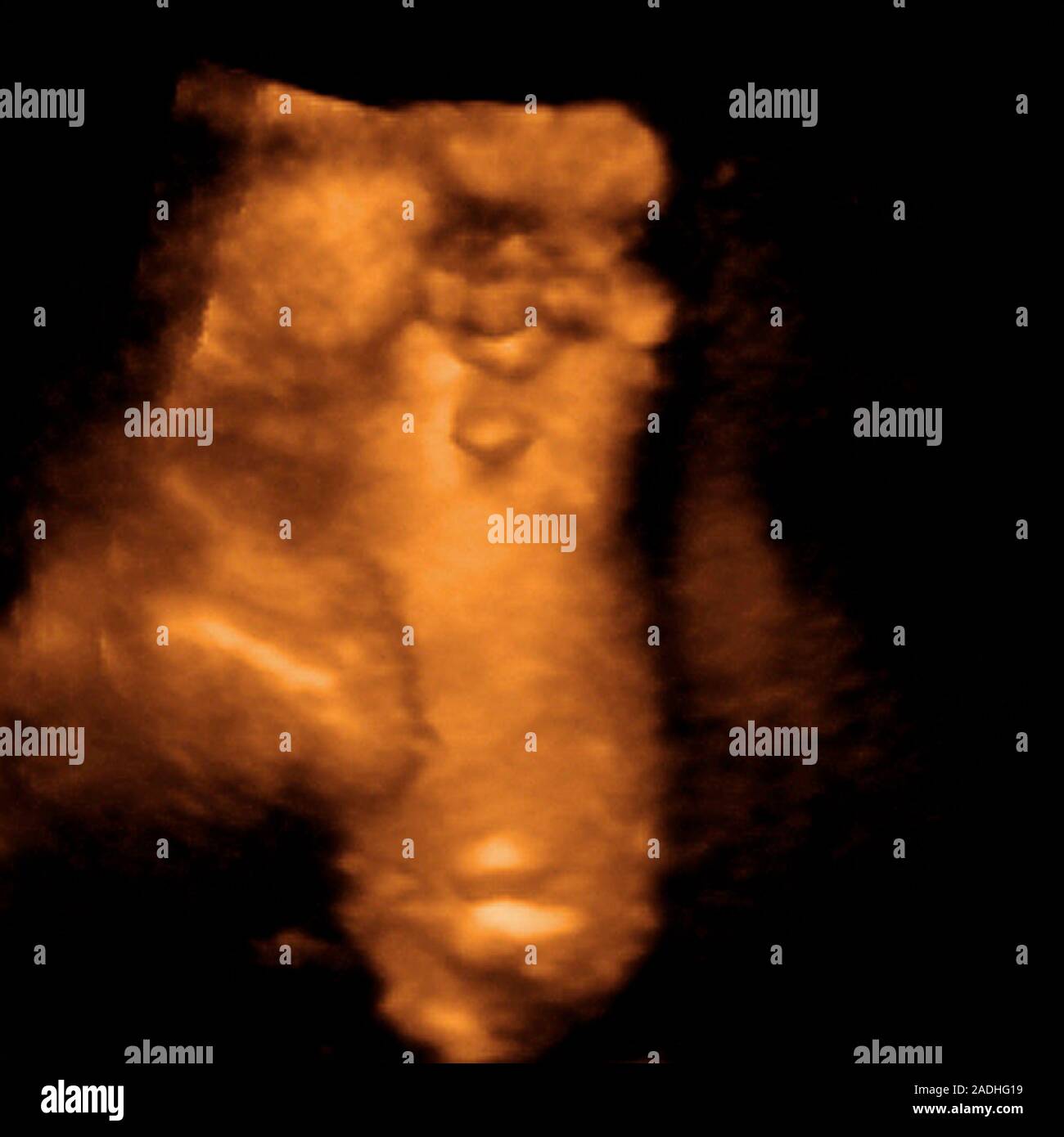 Gallstones. Coloured 3D ultrasound scan of gallstones (balls at upper ...