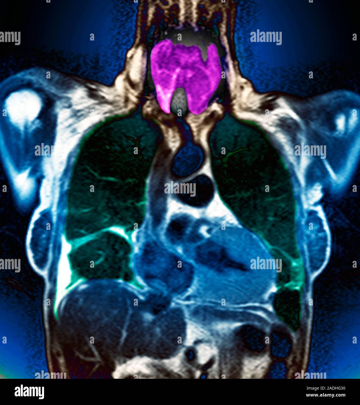 Swollen thyroid gland. Coloured coronal magnetic resonance imaging (MRI ...