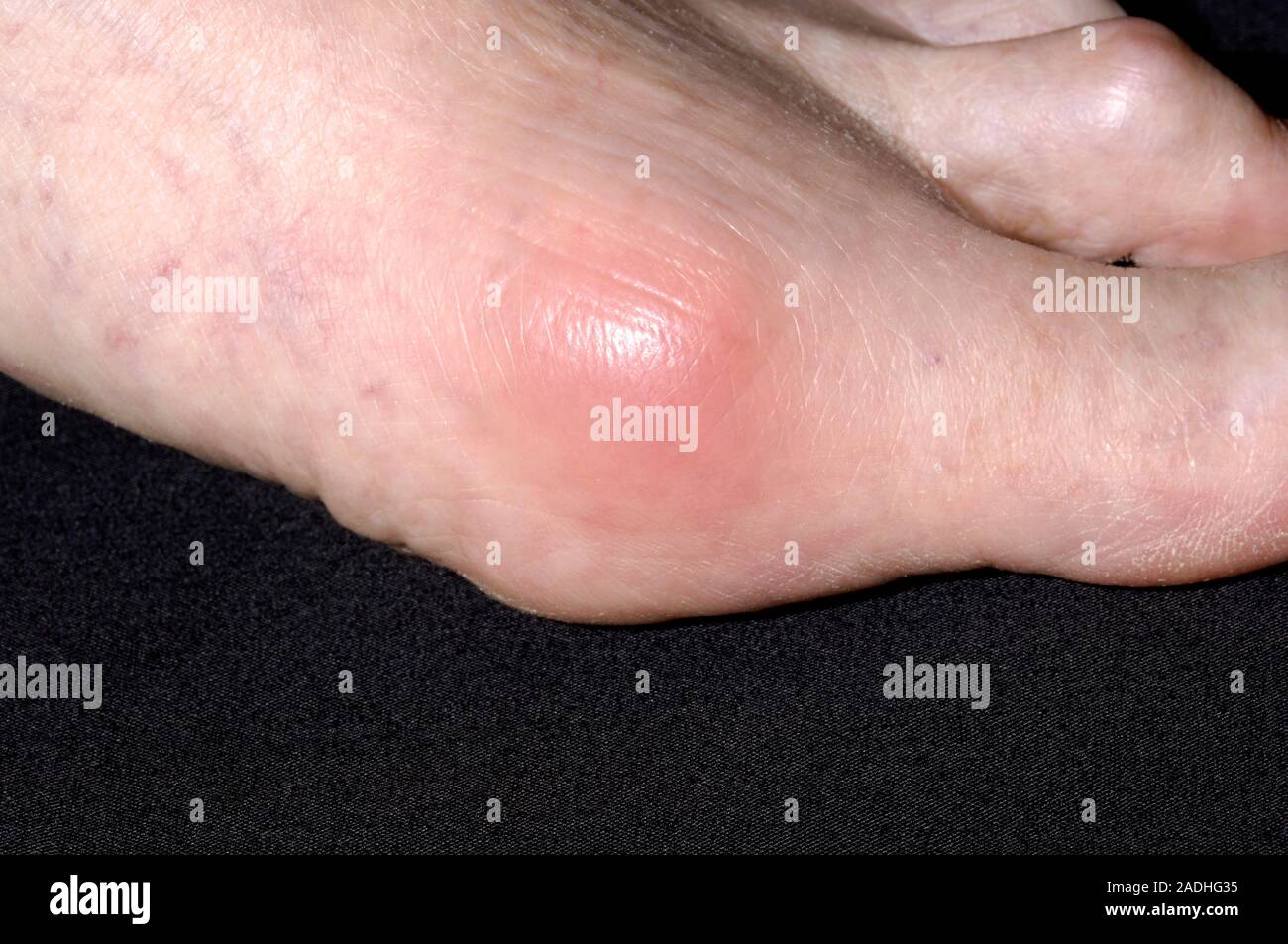Gout causing swelling (red) at the base of an 81-year-old woman's big ...